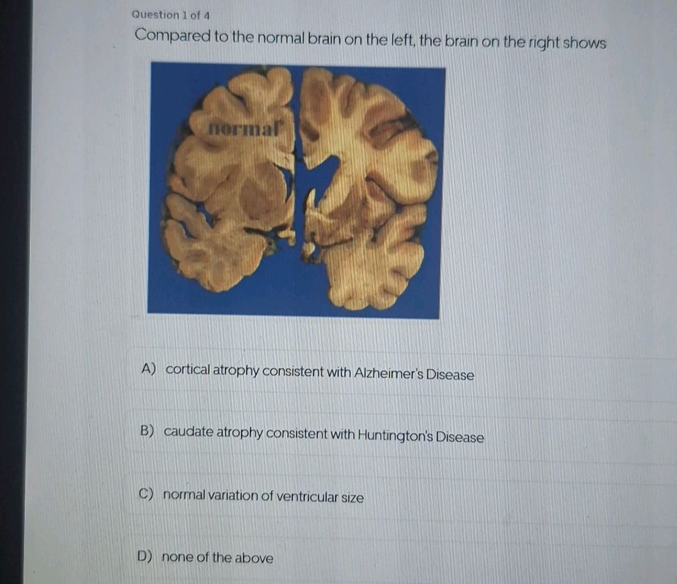 Compared to the normal brain on the left, | StudyX