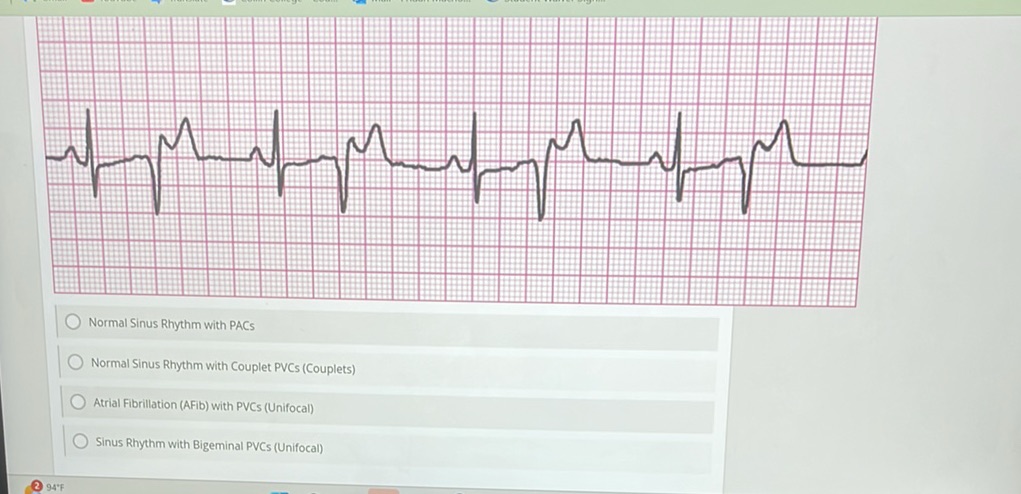 Normal Sinus Rhythm with PACs Normal Sinus