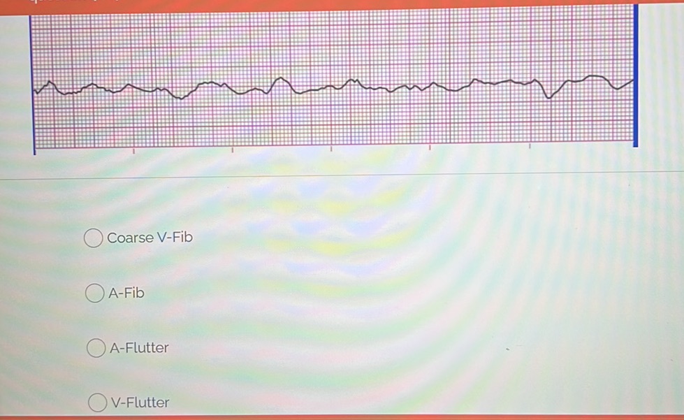 ECG interpretation: Coarse V-Fib, A-Fib, | StudyX