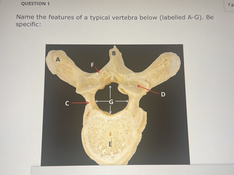 Name the features of a typical vertebra