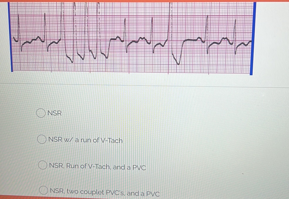 NSR NSR w/ a run of V-Tach NSR, Run of | StudyX