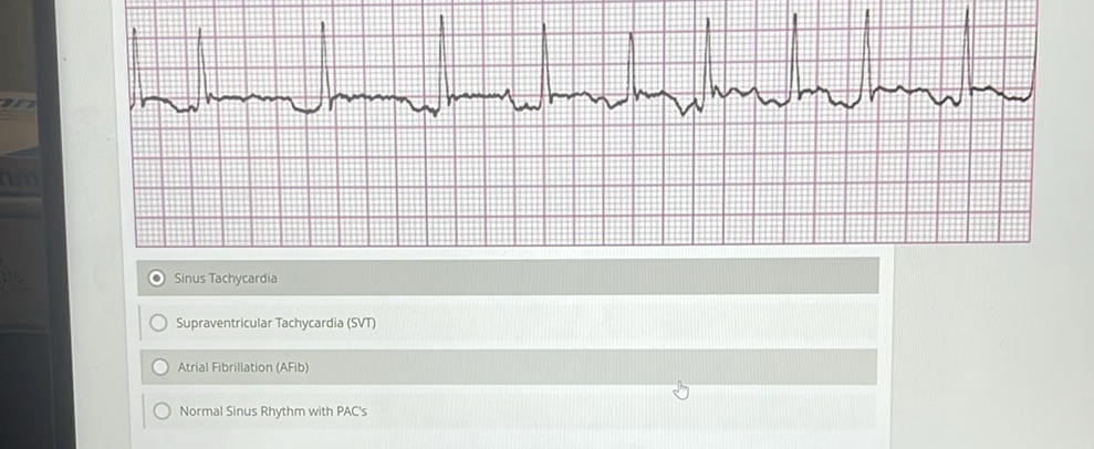 Sinus Tachycardia Supraventricular