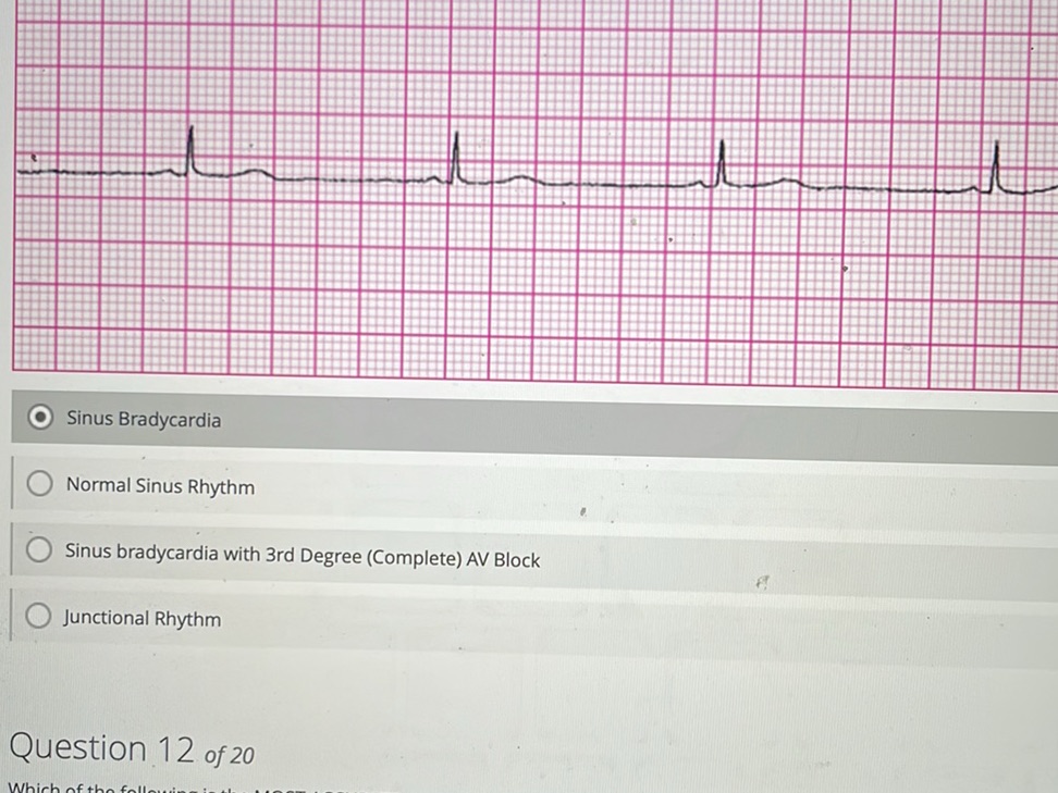 Sinus Bradycardia Normal Sinus Rhythm Sinus | StudyX