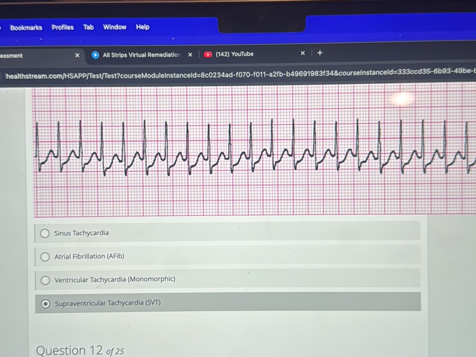 Sinus Tachycardia Atrial Fibrillation (AFib)