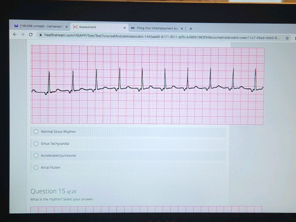 Normal Sinus Rhythm Sinus Tachycardia | StudyX