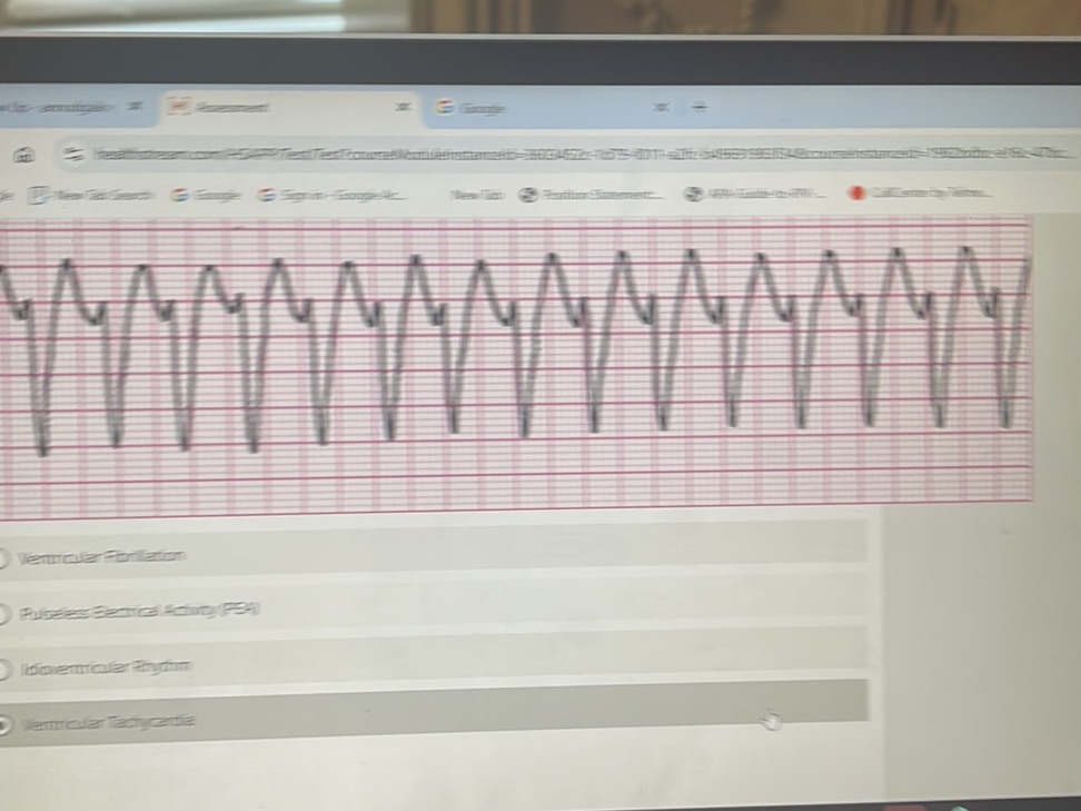 Ventricular Fibrillation Pulseless | StudyX