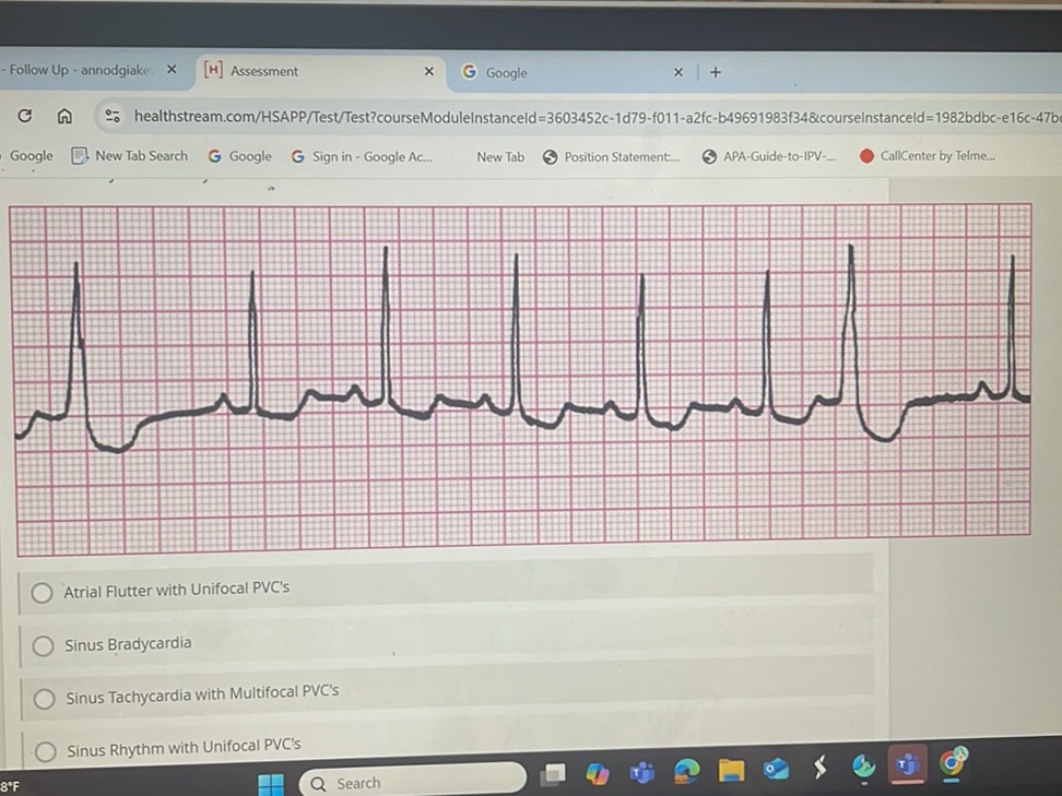 Atrial Flutter with Unifocal PVC's Sinus | StudyX