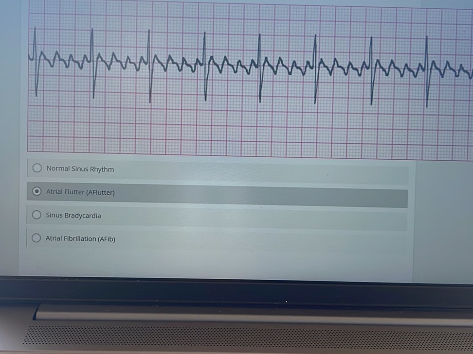 Normal Sinus Rhythm Atrial Flutter | StudyX