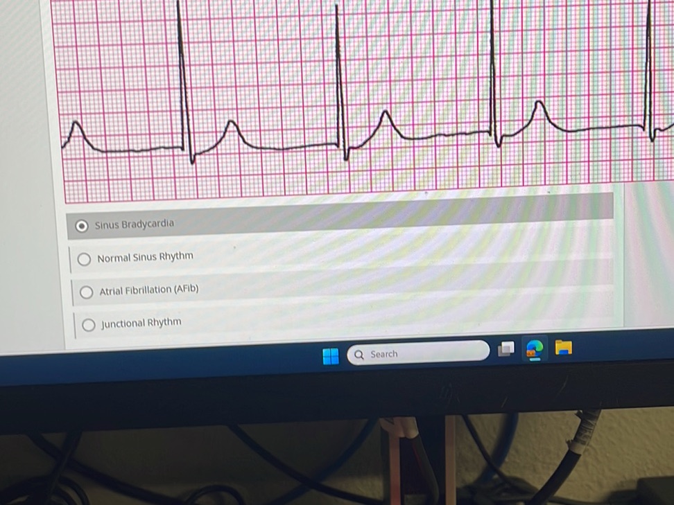 Sinus Bradycardia Normal Sinus Rhythm Atrial | StudyX