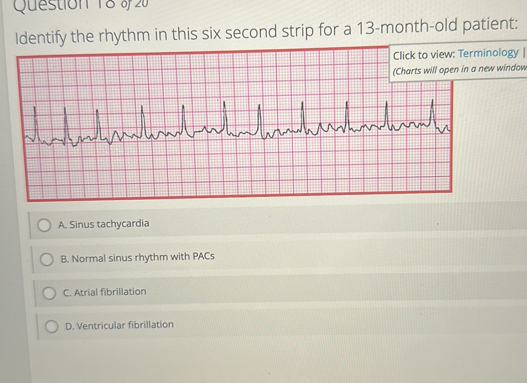Identify the rhythm in this six second strip | StudyX