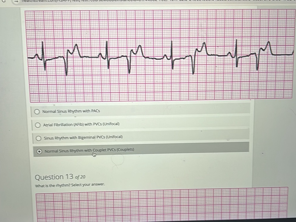 Normal Sinus Rhythm with PACs Atrial | StudyX