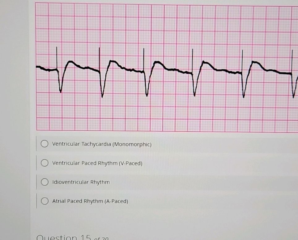 Ventricular Tachycardia (Monomorphic) | StudyX
