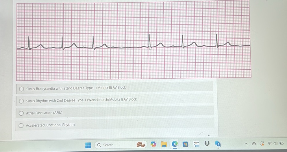 Sinus Bradycardia with a 2nd Degree Type II | StudyX