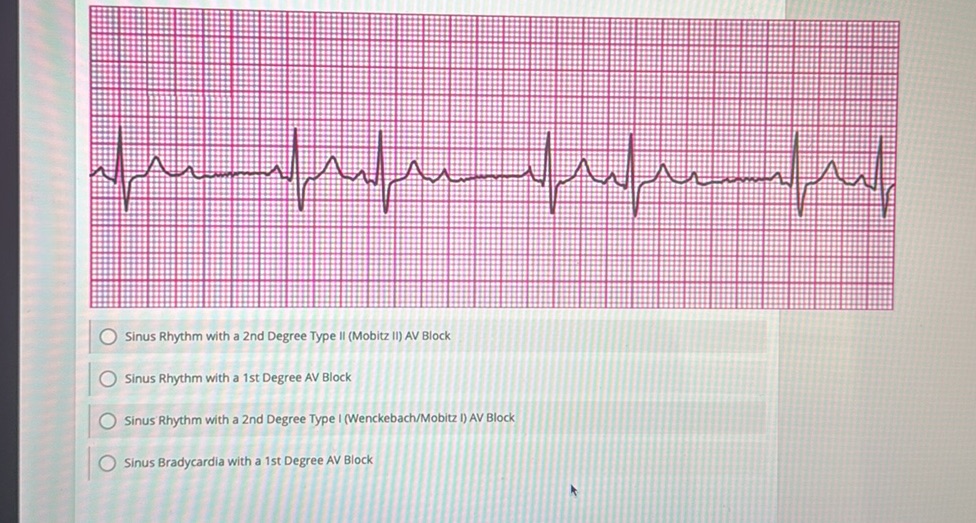 Sinus Rhythm with a 2nd Degree Type II