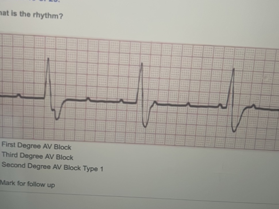 What is the rhythm? First Degree AV Block | StudyX