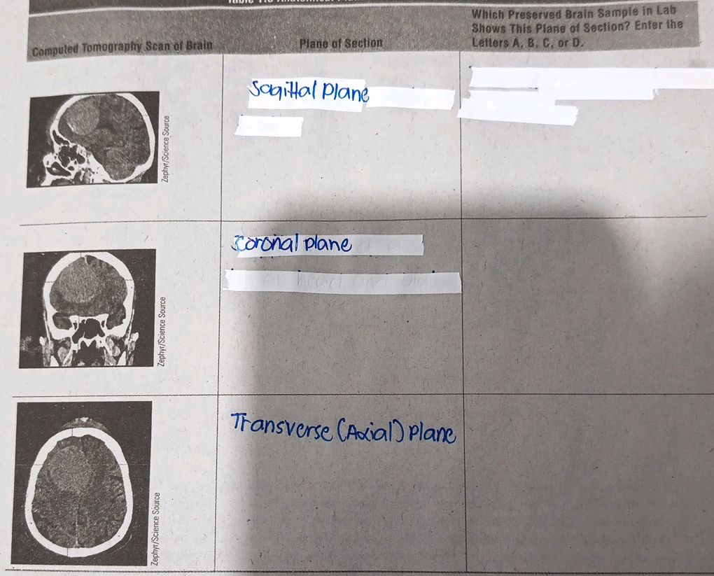 Computed Tomography Scan of Brain Plane of | StudyX