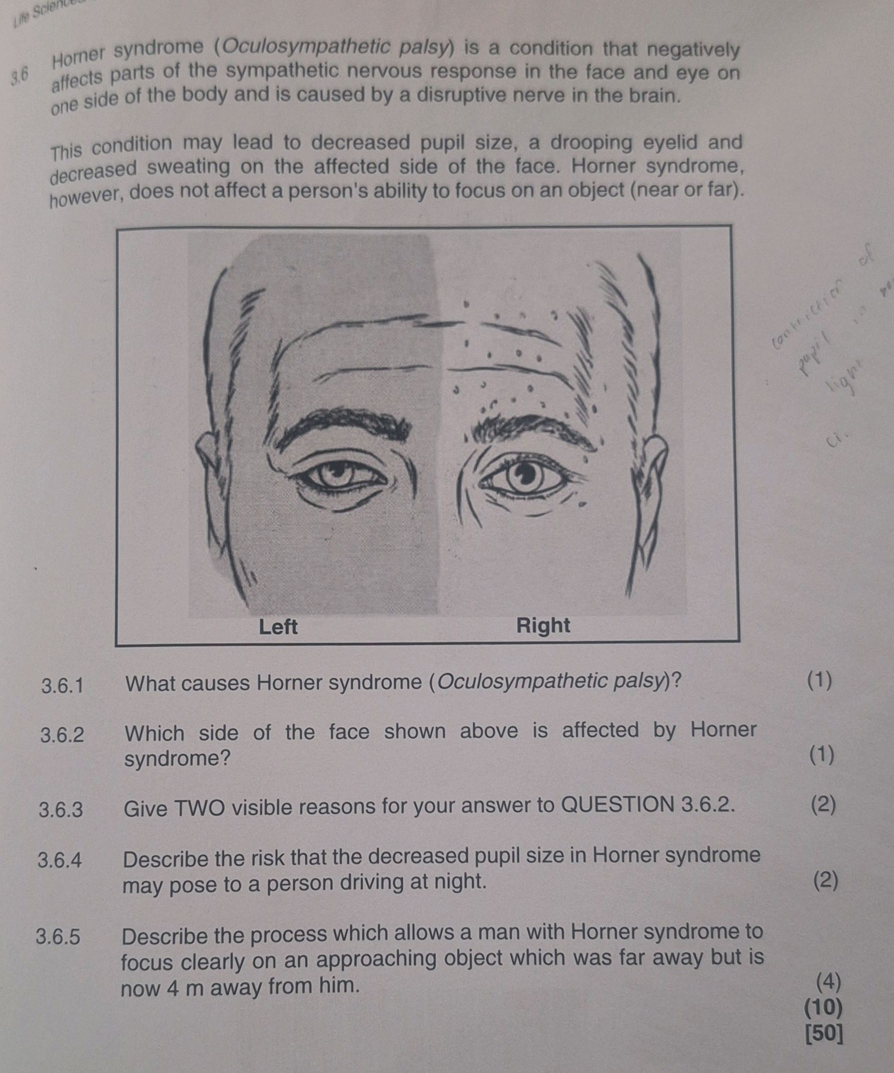 Horner syndrome (Oculosympathetic palsy) is | StudyX