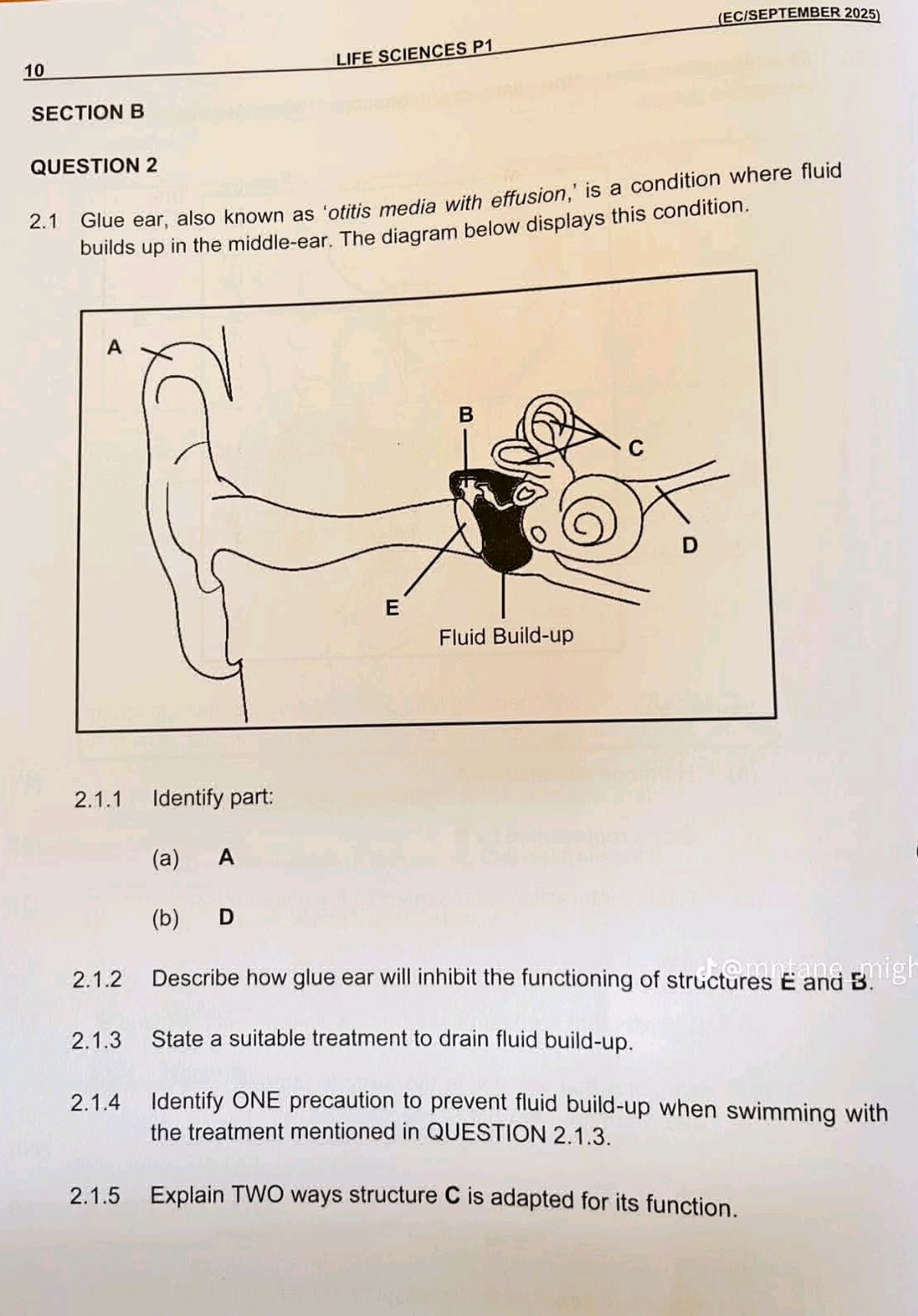 2.1 Glue ear, also known as 'otitis media | StudyX