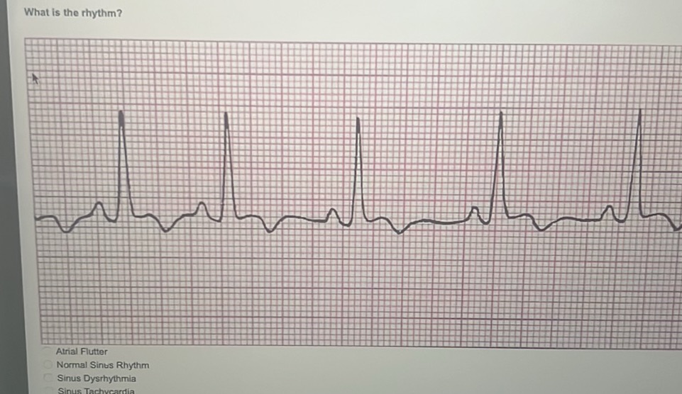 What is the rhythm? Atrial Flutter Normal | StudyX