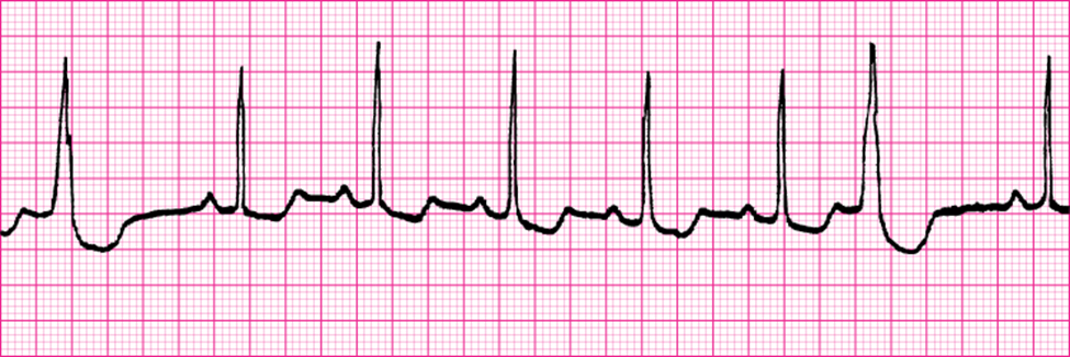 ECG Rhythm with PVCs | StudyX