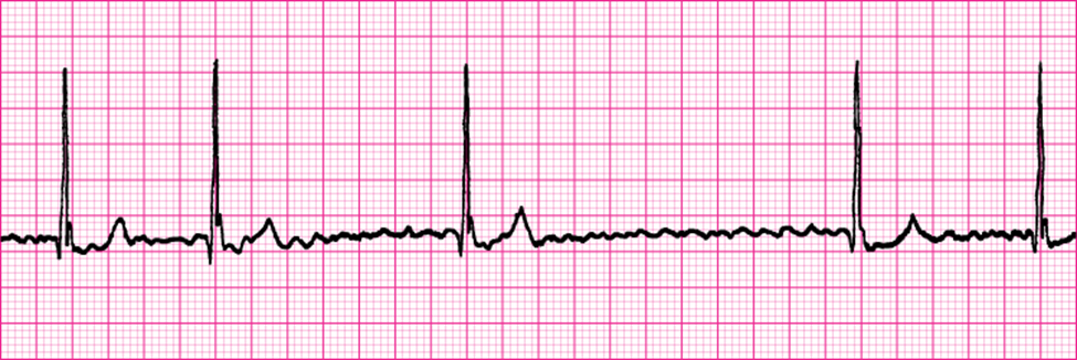 Interpreting ECG Rhythm | StudyX