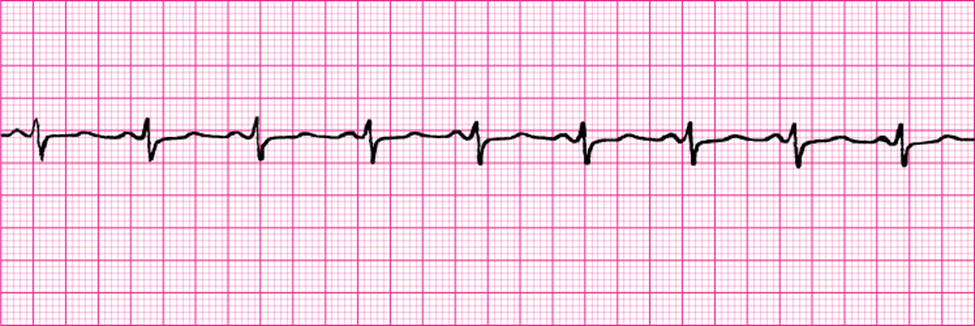 The image shows an ECG rhythm. The rhythm