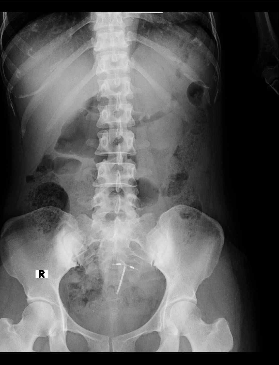 The image is an X-ray of the abdomen and | StudyX