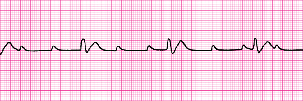 DETERMINE SINUS RHYTHM WITH A 1ST DEGREE AV | StudyX