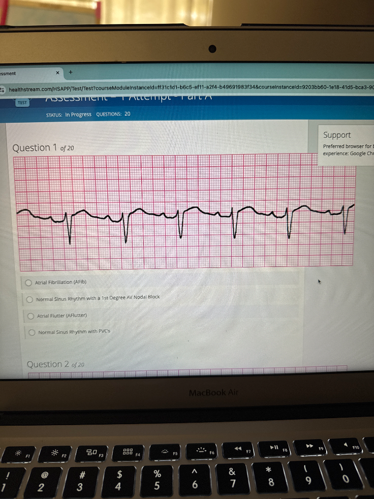 Question 1 of 20 Atrial Fibrillation (AFib) | StudyX
