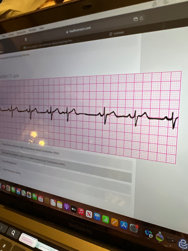 Normal Sinus Rhythm with a Premature Atrial | StudyX