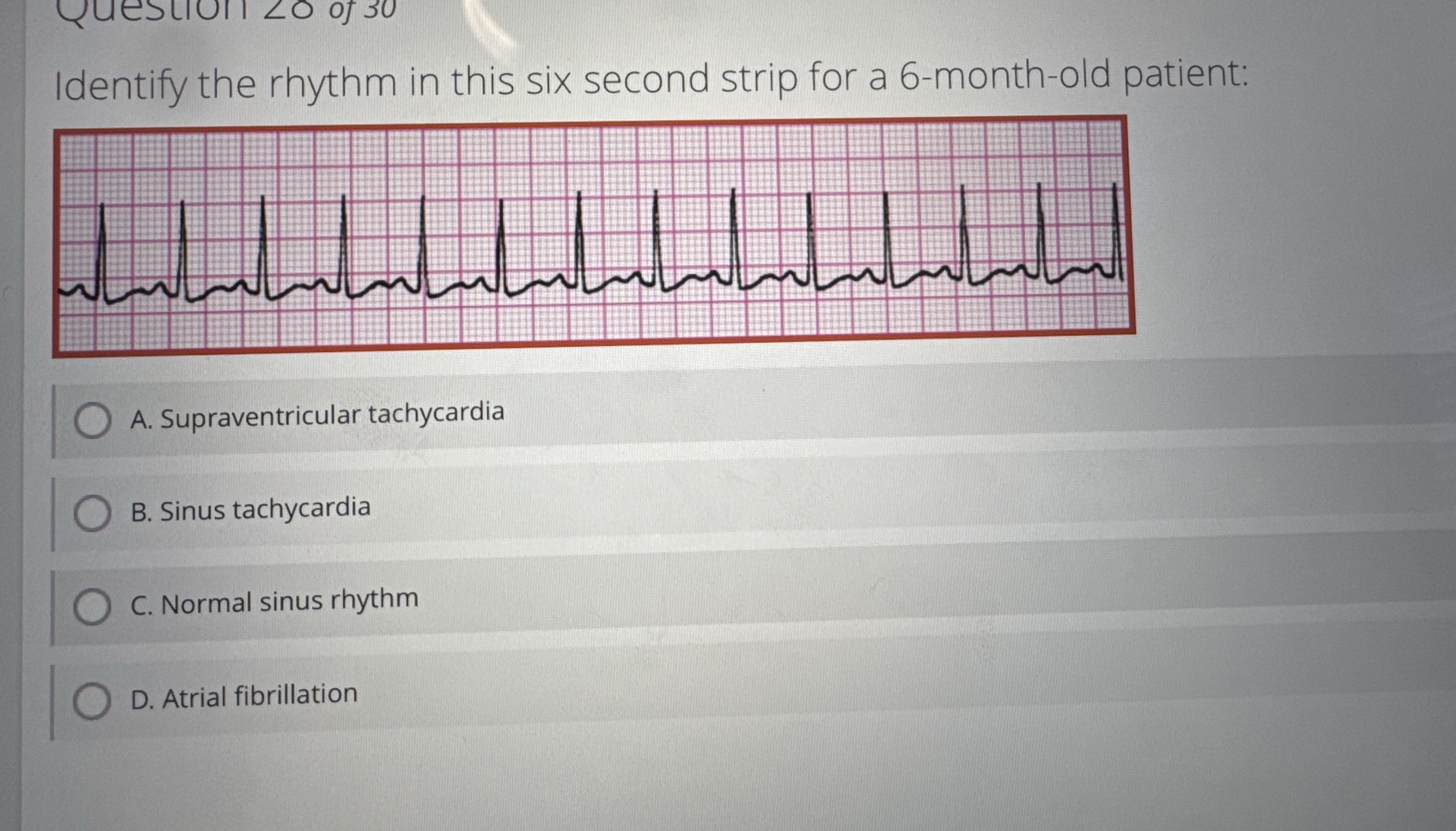 Identify the rhythm in this six second strip | StudyX