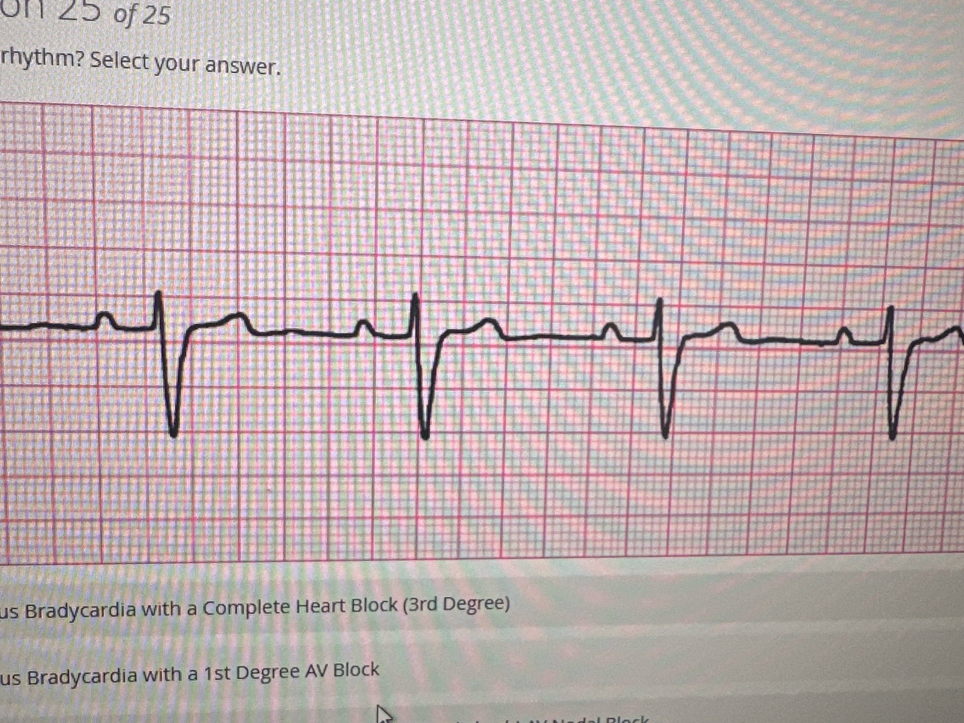 rhythm? Select your answer. Sinus | StudyX