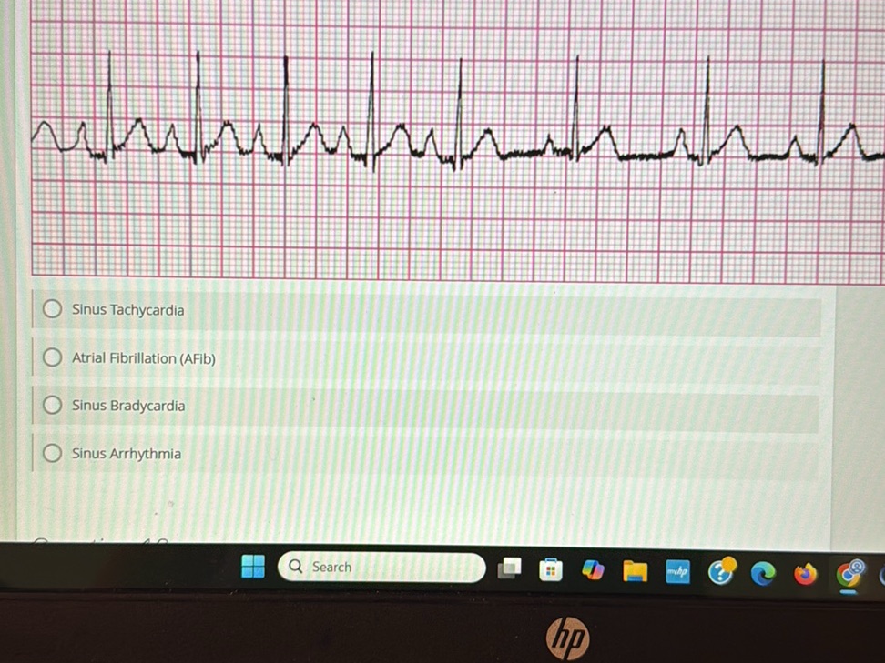 Sinus Tachycardia Atrial Fibrillation | StudyX