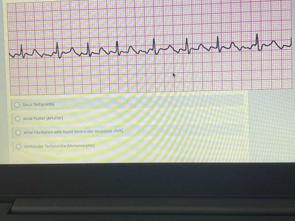 Sinus Tachycardia Atrial Flutter (AFlutter) | StudyX