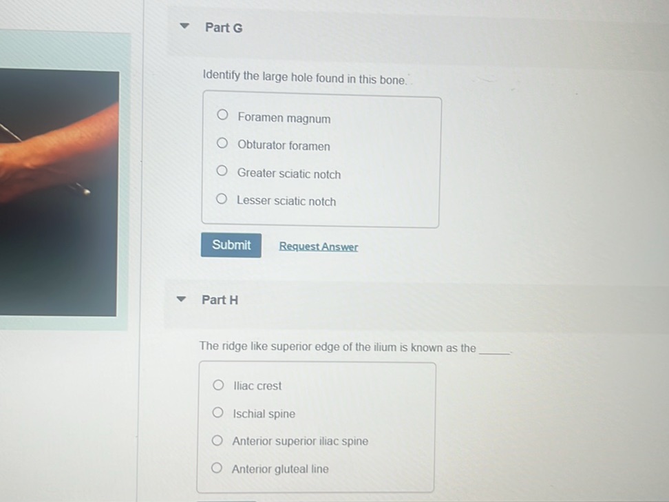Identify the large hole found in this bone. | StudyX