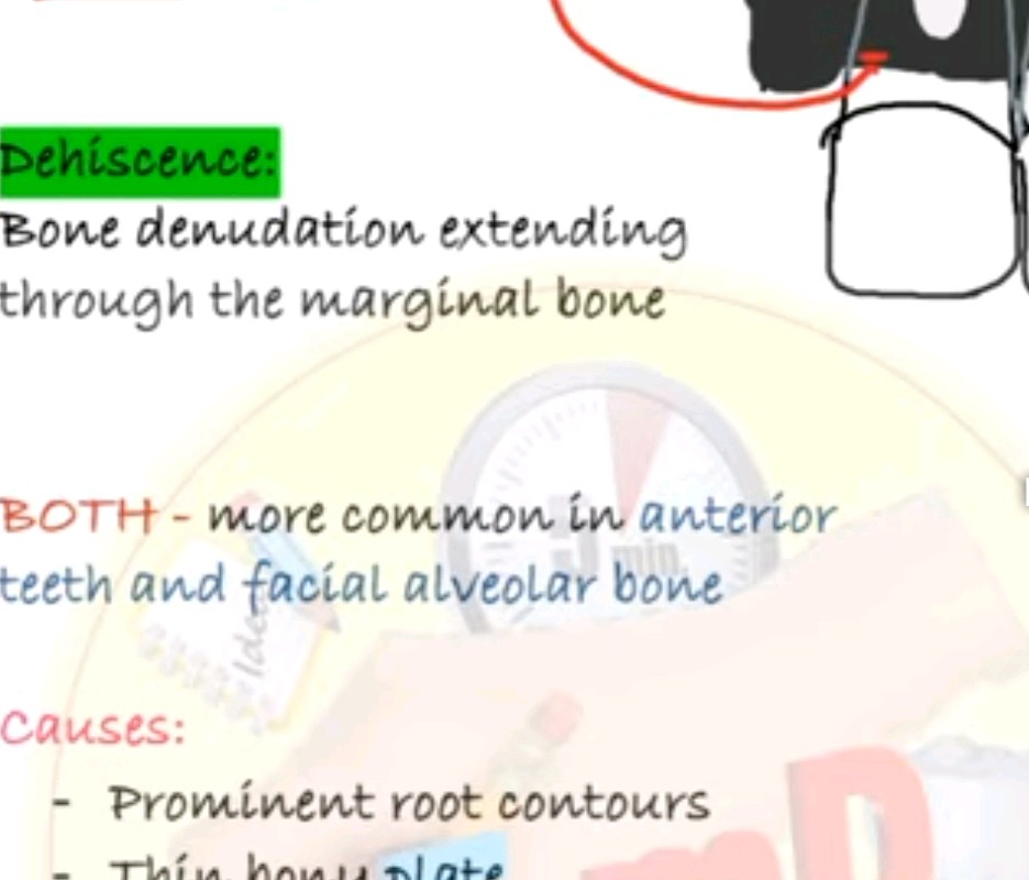 Dehiscence Bone denudation extending through | StudyX