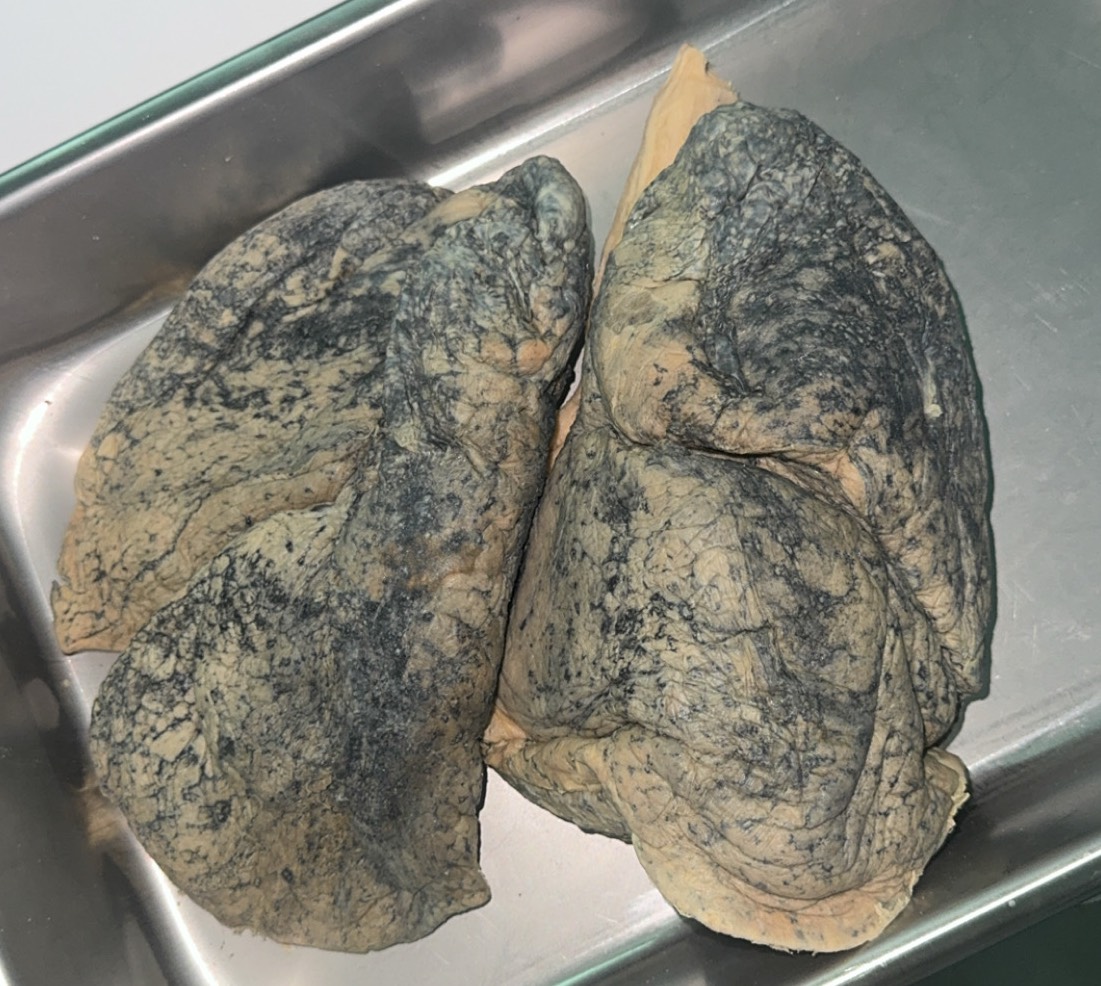 The image shows a pair of lungs severely | StudyX