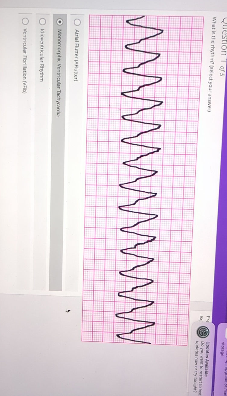 What is the rhythm? (select your answer) | StudyX
