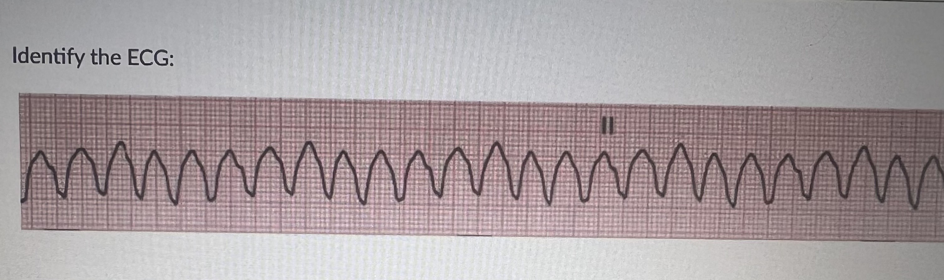 Identify ECG Rhythm | StudyX