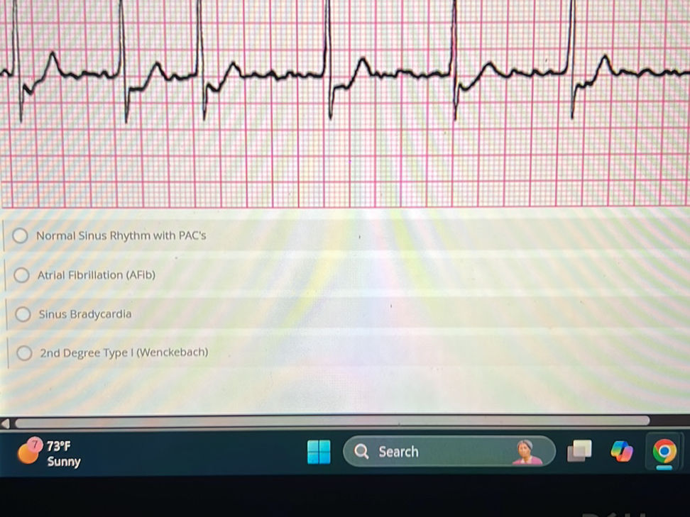 Normal Sinus Rhythm with PAC's Atrial | StudyX