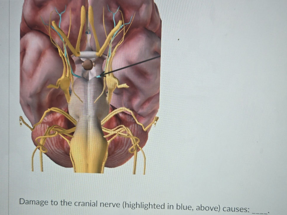 Damage to the cranial nerve (highlighted in | StudyX