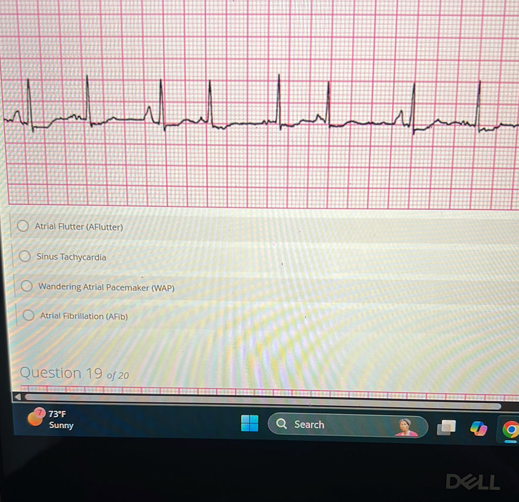 Atrial Flutter (AFlutter) Sinus Tachycardia | StudyX