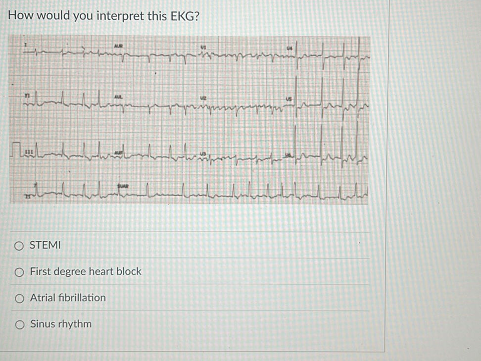 How would you interpret this EKG? O STEMI O | StudyX