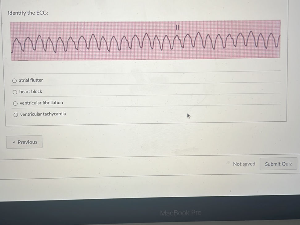 Identify the ECG: O atrial flutter O heart | StudyX