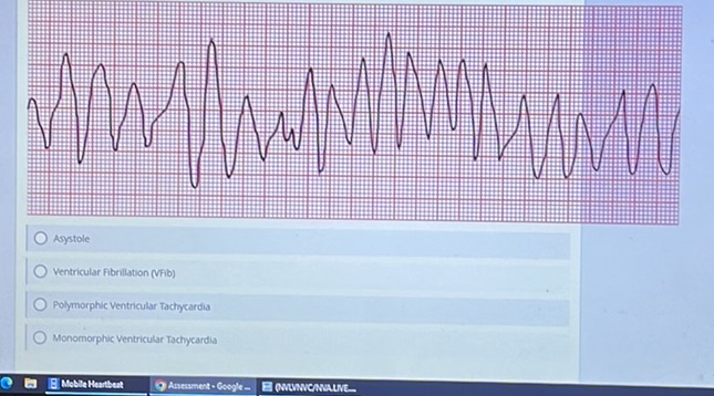 Asystole Ventricular Fibrillation (VFib) | StudyX