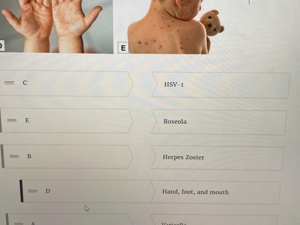 C HSV-1 E Roseola B Herpes Zoster D Hand,