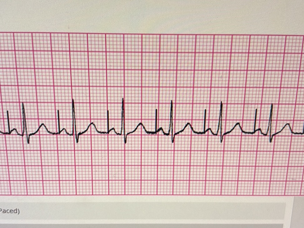 The image shows an ECG tracing. The | StudyX