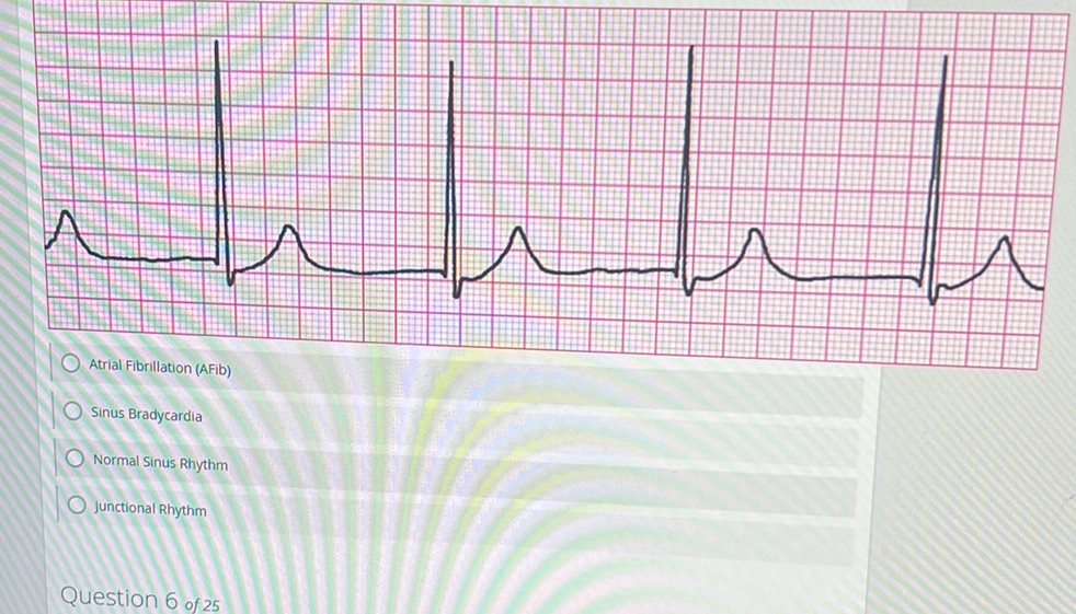 Atrial Fibrillation (AFib) Sinus | StudyX