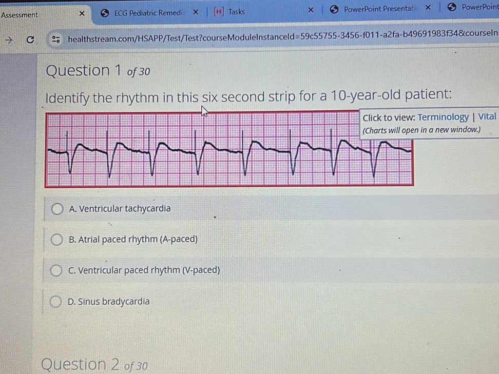 Identify the rhythm in this six second strip | StudyX