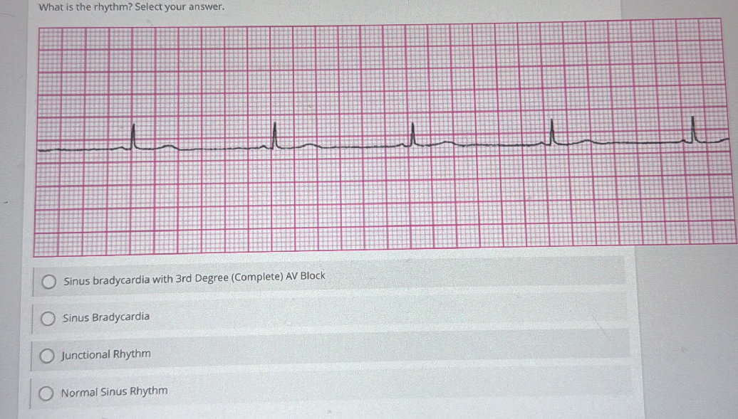 What is the rhythm? Select your answer. | StudyX